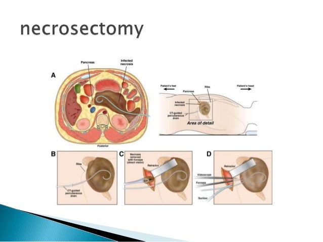 Acute pancreatitis investigations and treatment