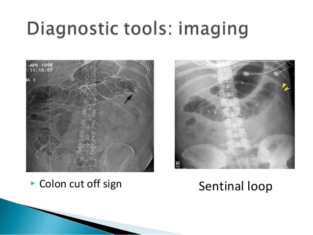 Acute pancreatitis nikhil