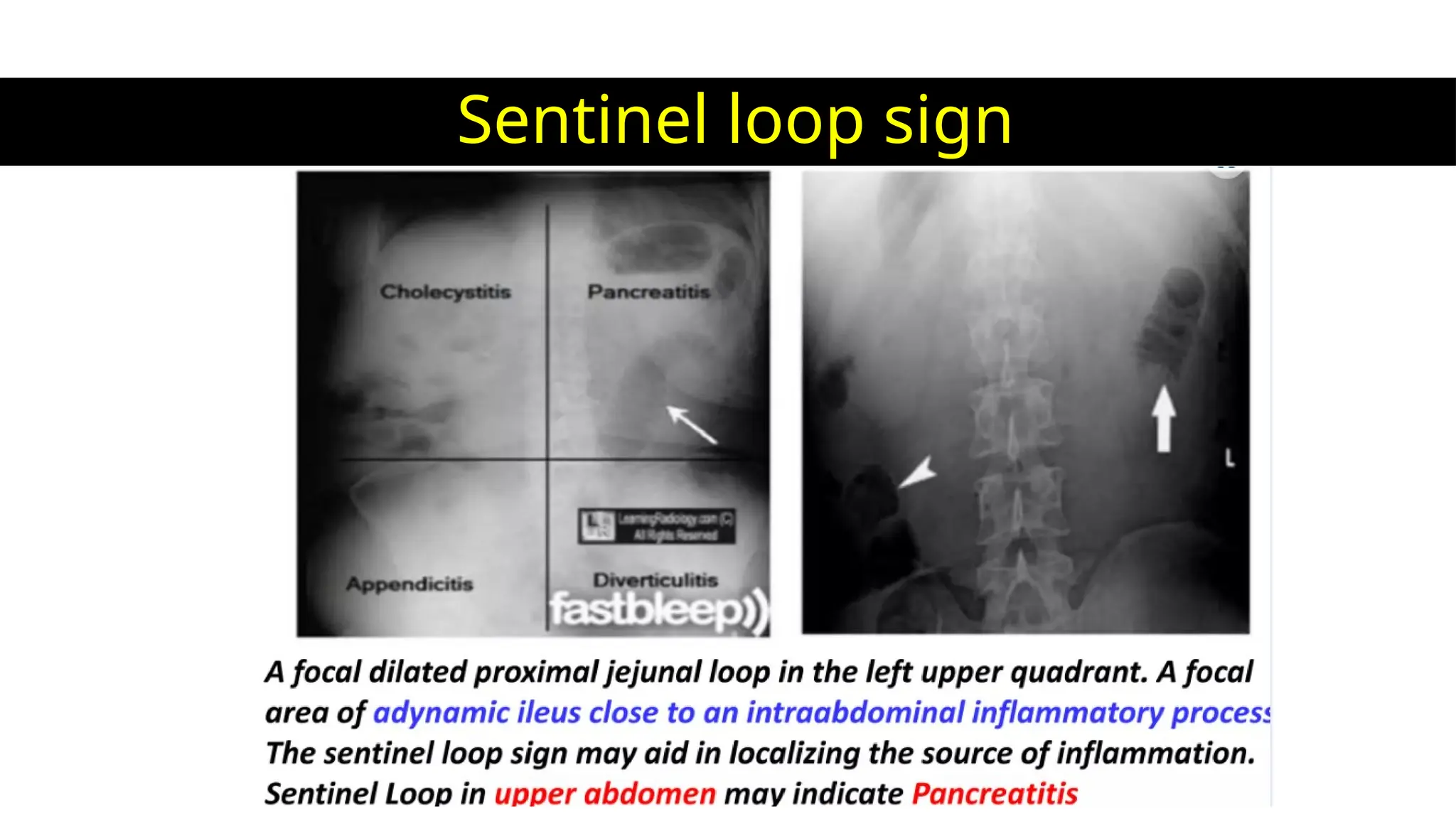 updated guidelies of acute pancreatitis .pptx