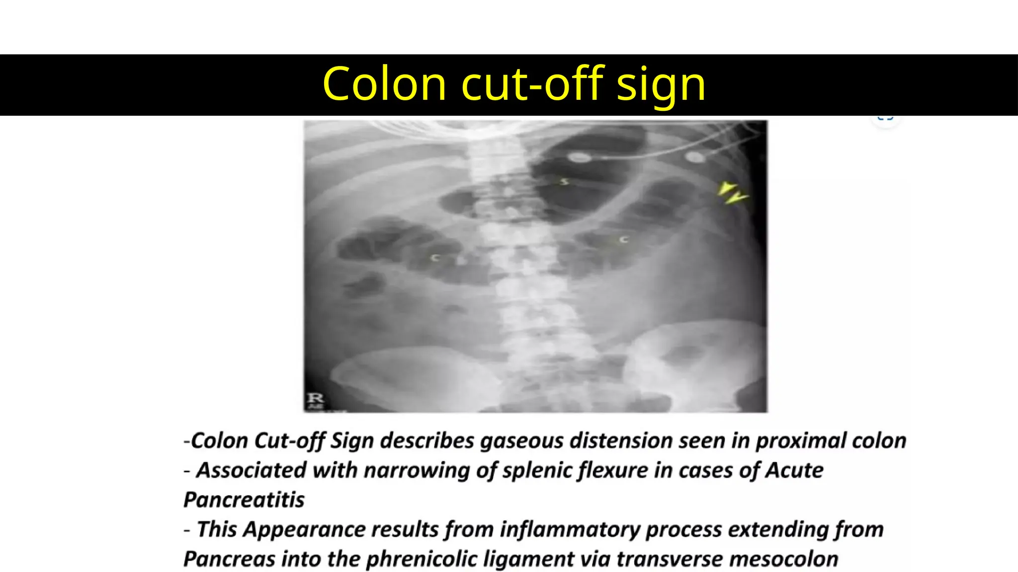updated guidelies of acute pancreatitis .pptx