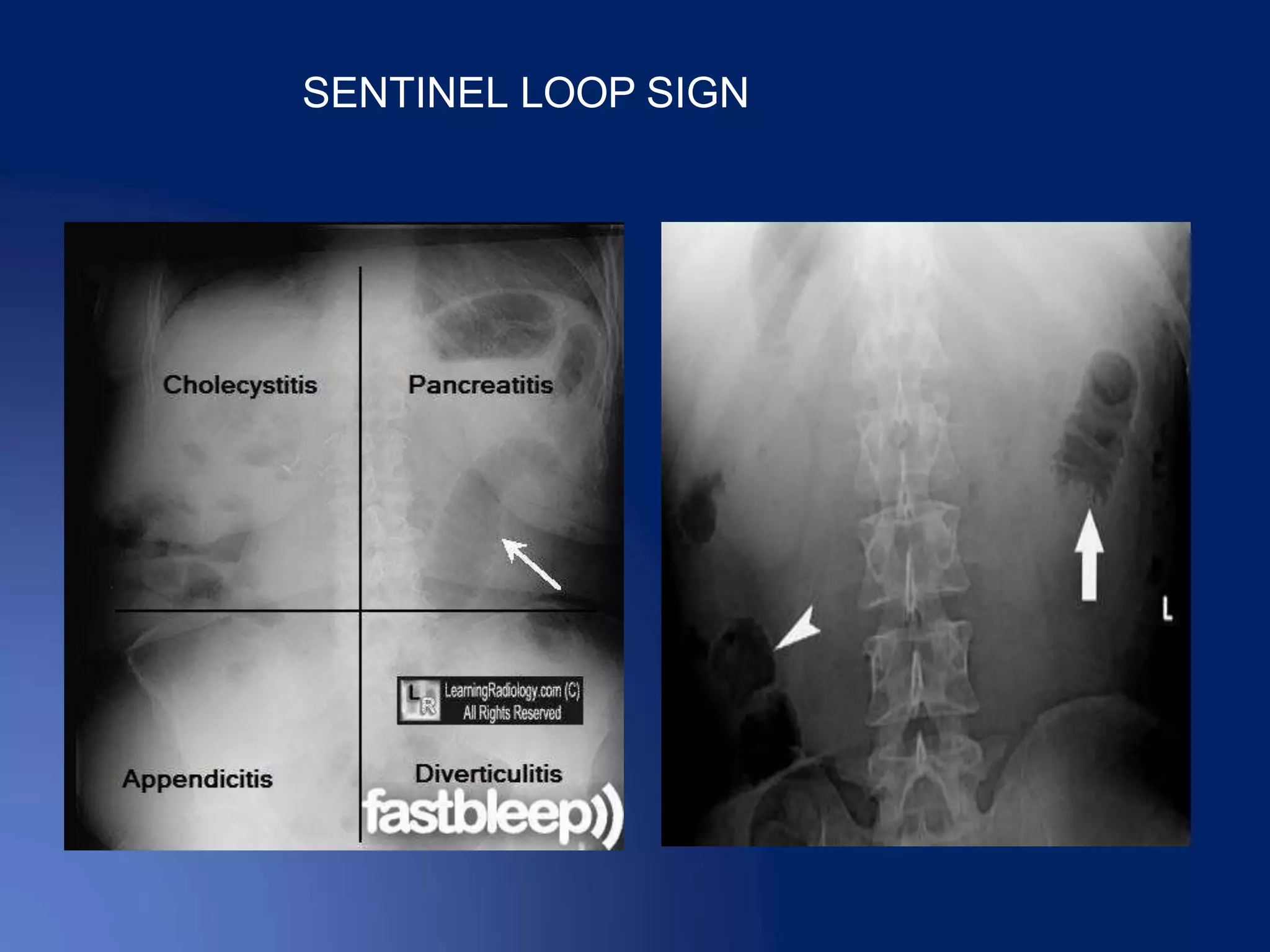 acute panctreatitis.pptx