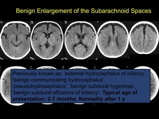 Acute Pediatric Neuroradiology: Pearls and Pitfalls (2020) | PPTX