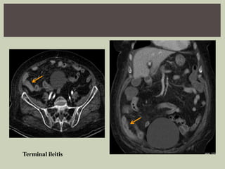 Acute female pelvic infection . ESUR Congress. | PPTX