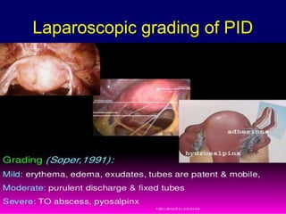 Acute pelvic inflammatory disease ( ahmed walid anwar morad) | PPT