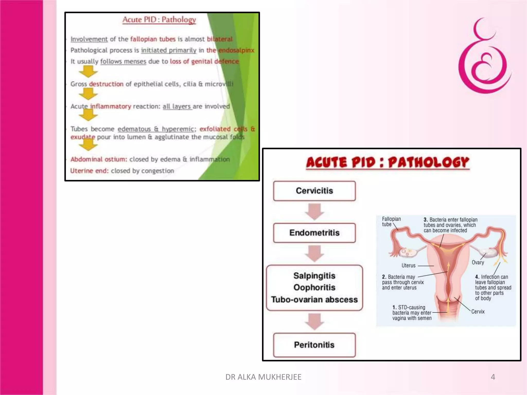 Acute pelvic inflammatory disease by dr alka mukherjee dr apurva ...