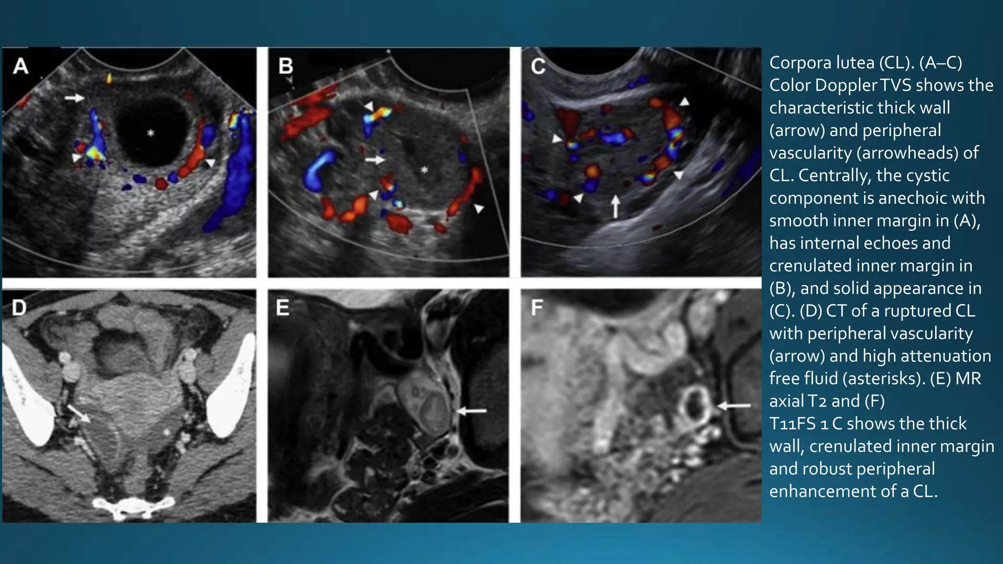 acute pelvic pain RADIOLOGY LECTURE.pptx