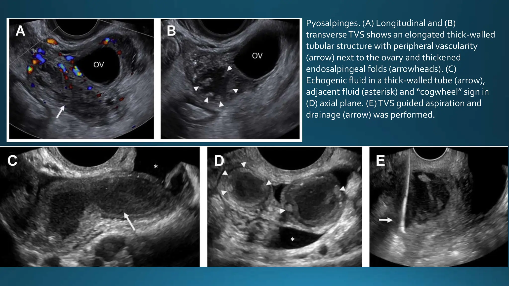 acute pelvic pain RADIOLOGY LECTURE.pptx