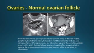 acute pelvic pain RADIOLOGY LECTURE.pptx
