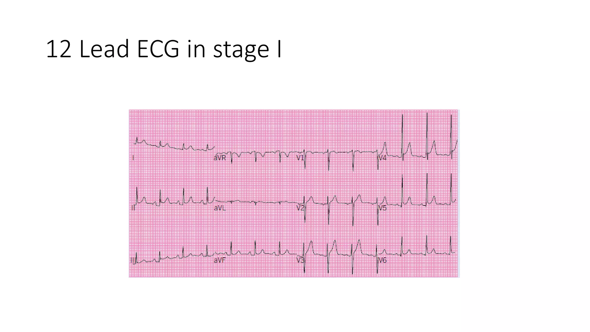 12 Lead ECG in acute pericarditis | PPTX | Heart and Cardiovascular ...