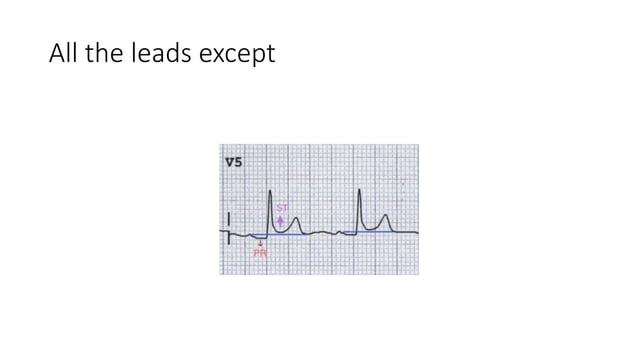 12 Lead ECG in acute pericarditis