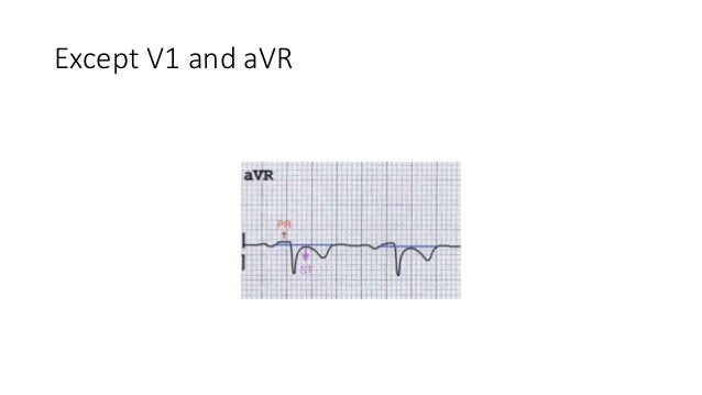 12 Lead ECG in acute pericarditis