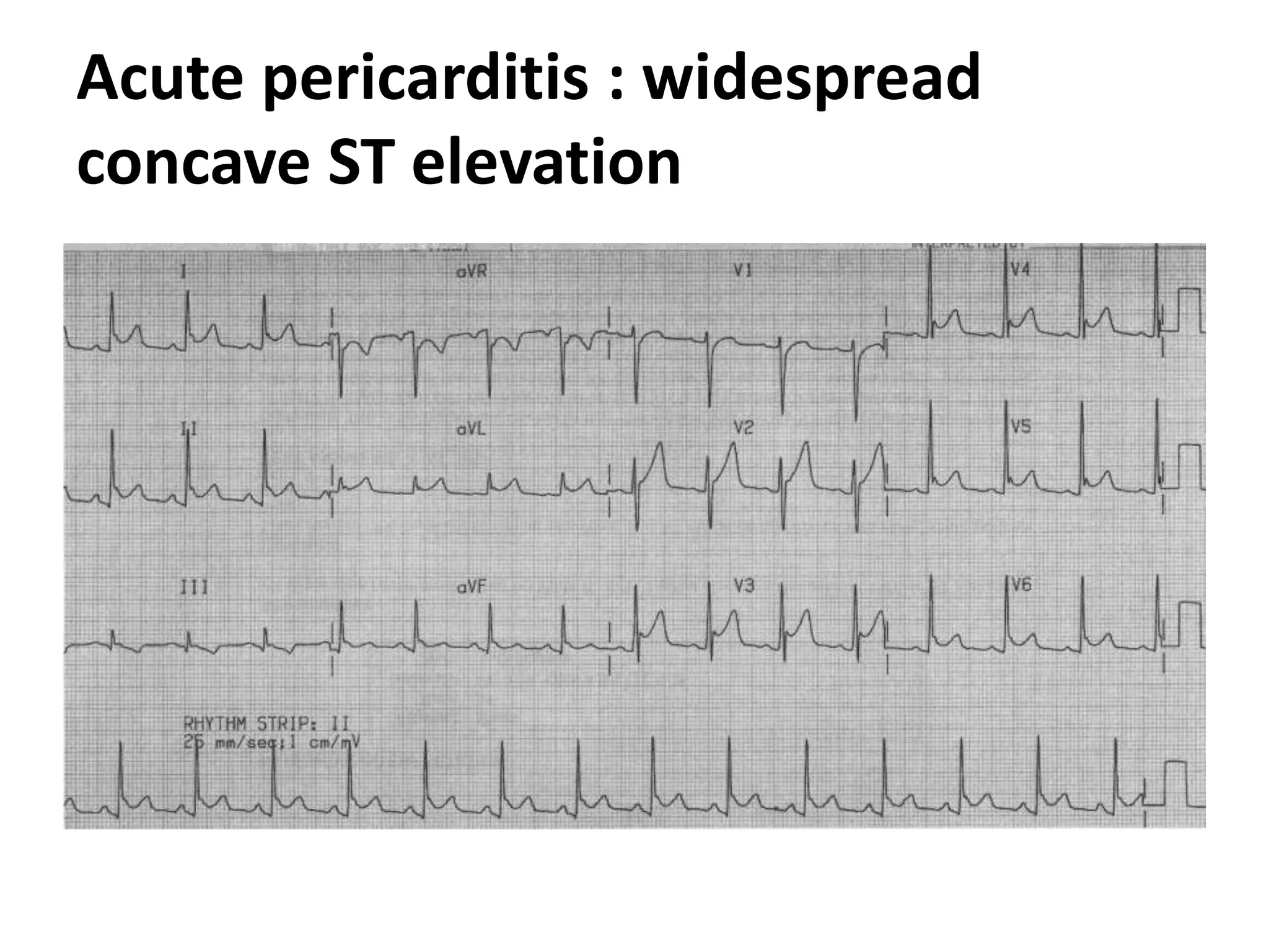 Acute pericarditis | PPTX