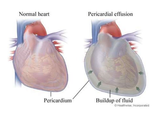 Acute pericarditis