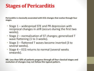 Acute Pericarditis.pptx