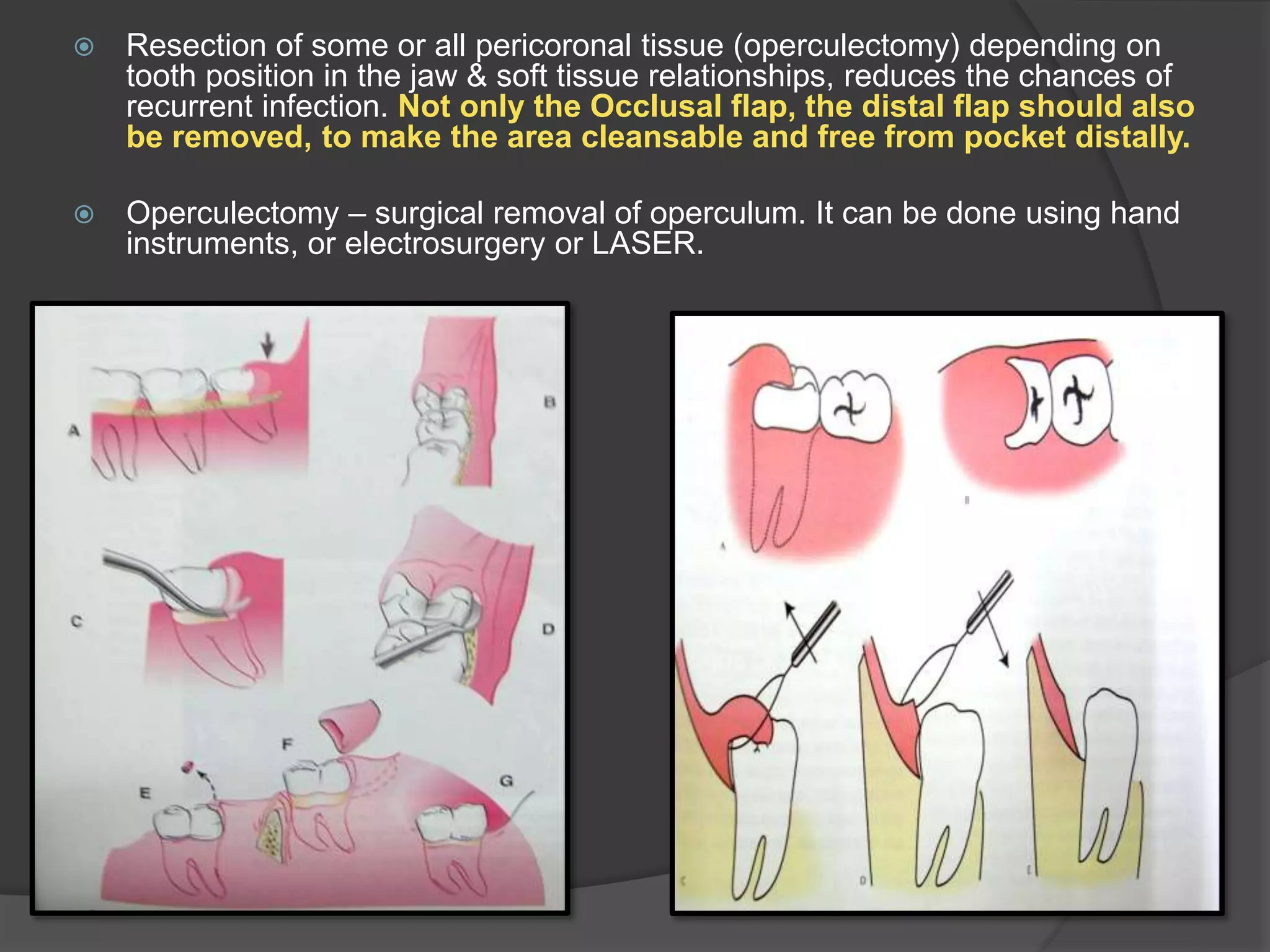 Acute periodontal Infections | PPTX
