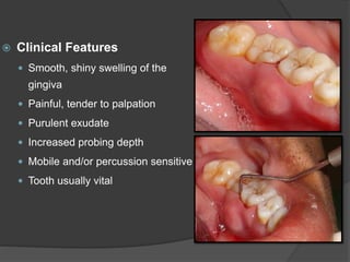 Purulent Exudate Teeth