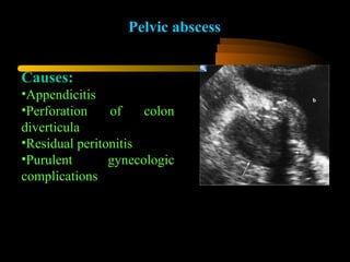Acute peritonitis | PPT
