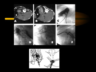 Acute peritonitis | PPT
