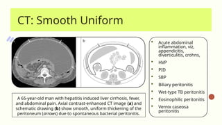Acute Peritonitis and Acute Mesenteric Ischemia: Pathophysiology ...
