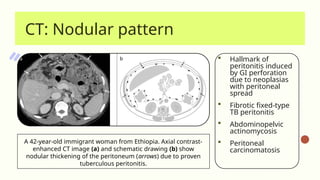 Acute Peritonitis and Acute Mesenteric Ischemia: Pathophysiology ...