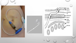 Acute Peritonitis In Continuous Ambulatory Peritoneal Dialysis Pptx