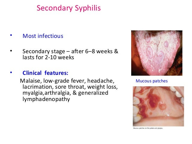 Acute pharyngitis