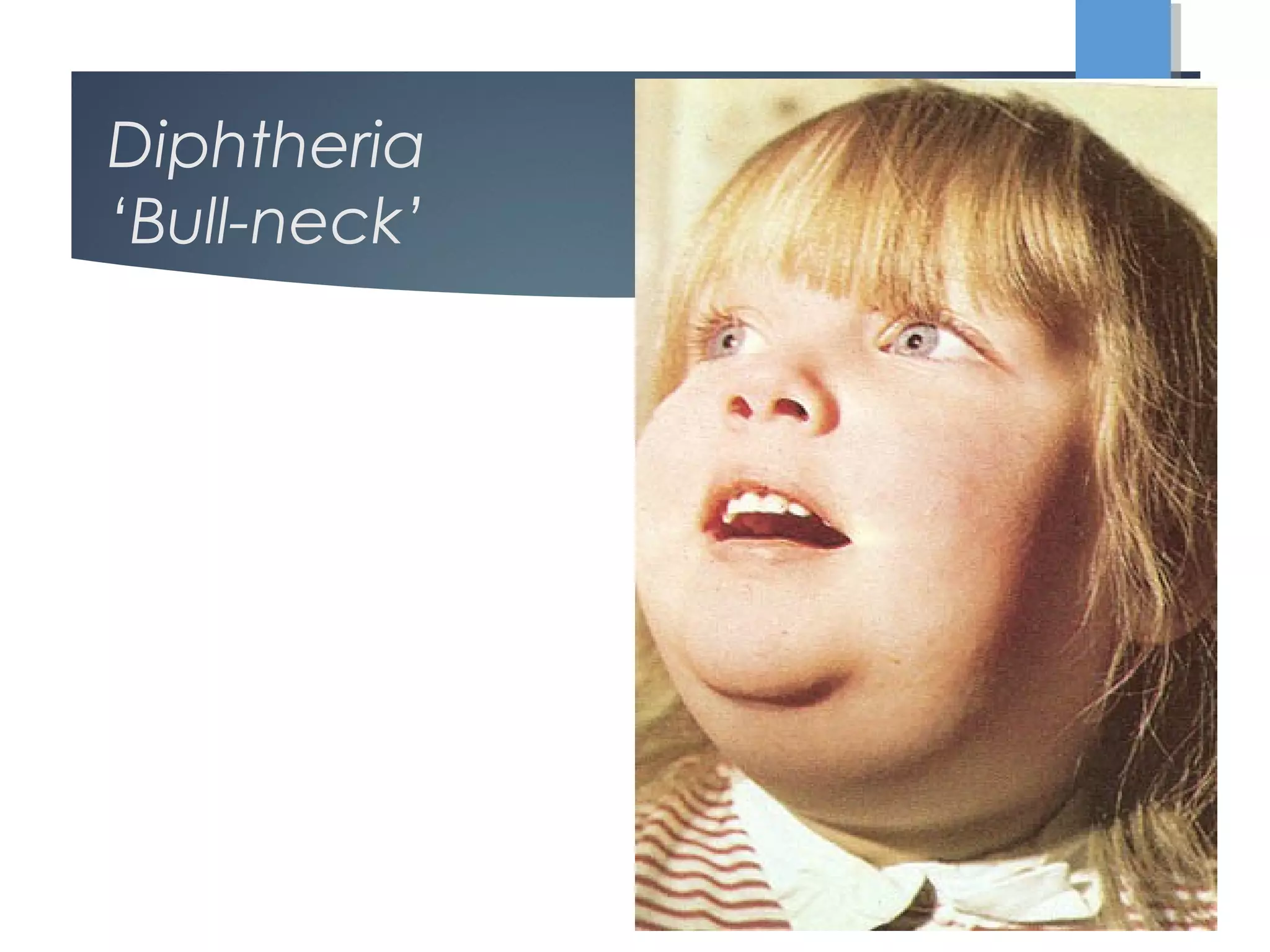 Acute pharyngitis | PPT