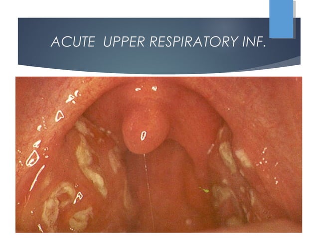 Acute pharyngitis | PPT | Ear, Nose and Throat Conditions | Diseases ...