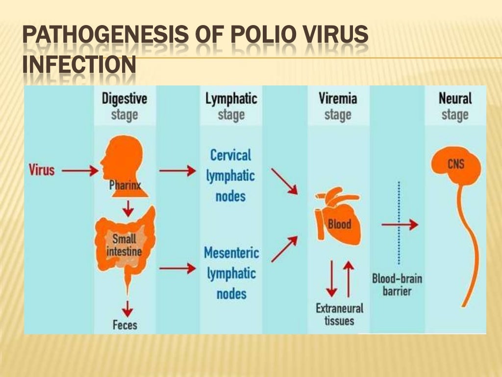 Acute poliomyelitis
