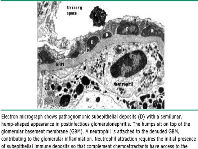 Acute post streptococcal glomerulonephritis