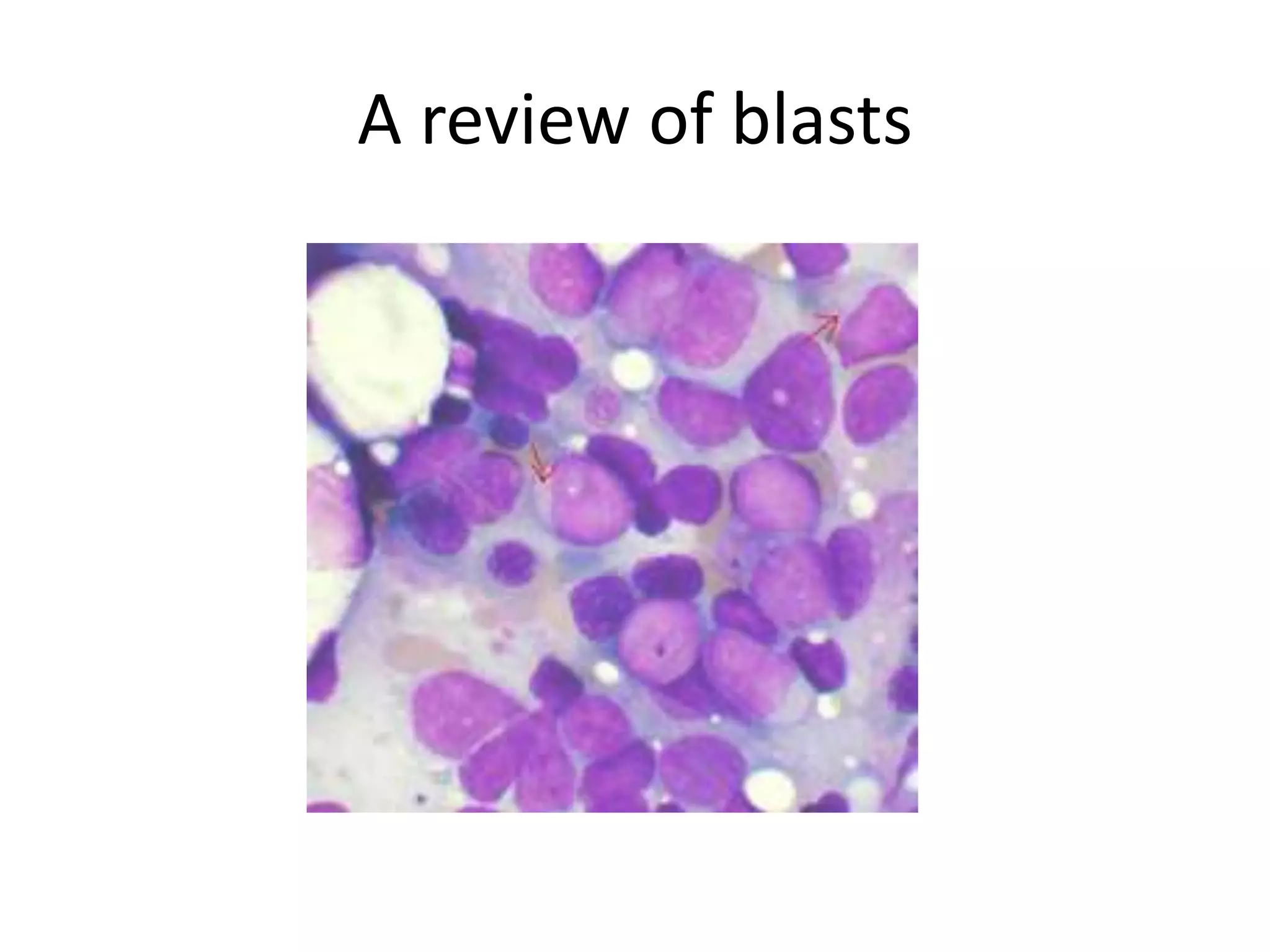 Acute promyelocytic leukemia | PPTX