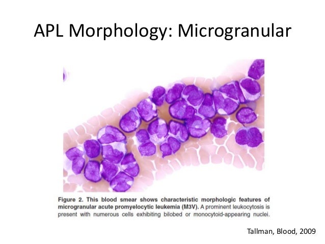 Acute promyelocytic leukemia