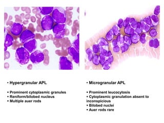Acute Promyelocytic Leukemia Microgranular Variant