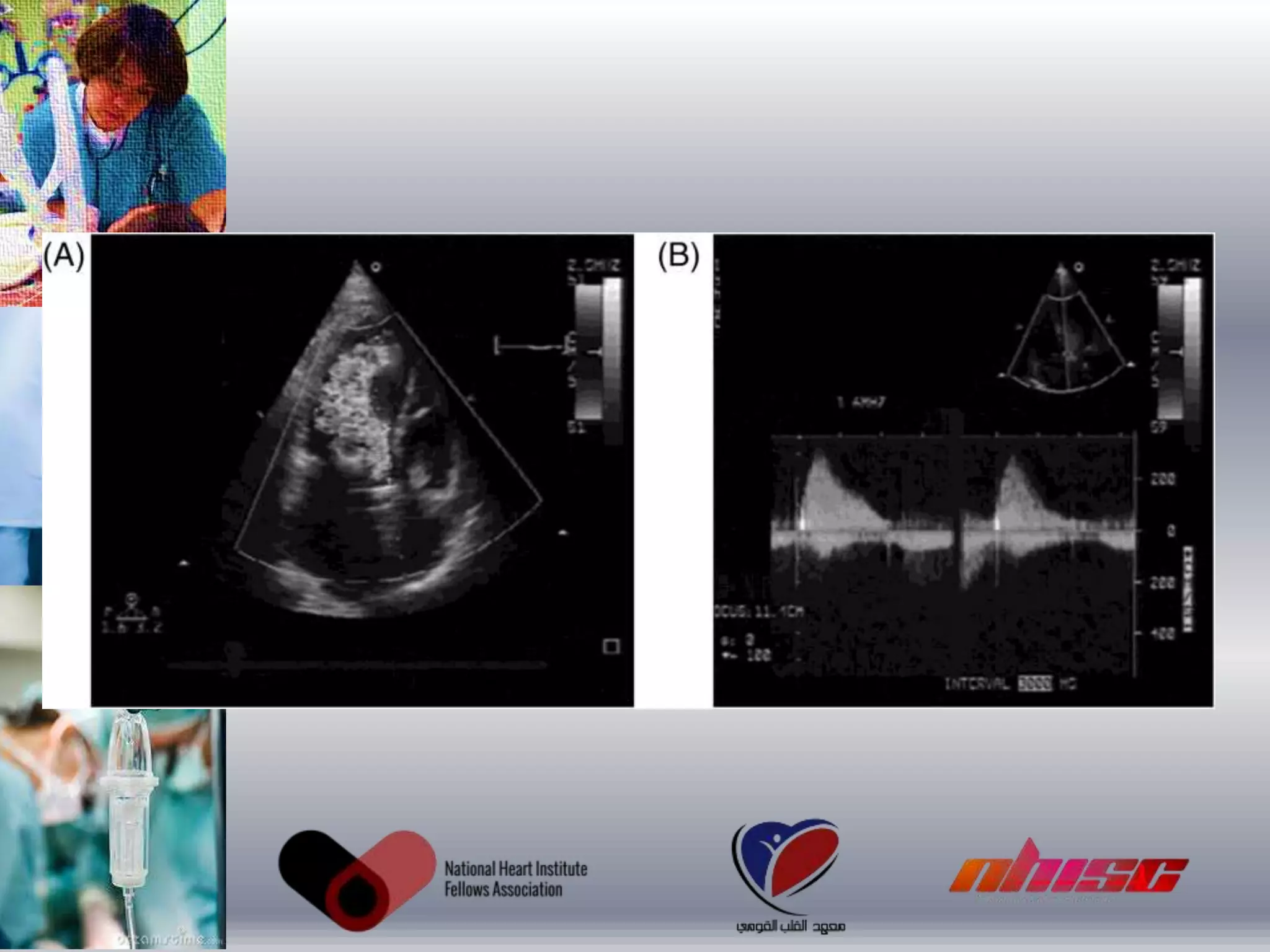 Acute prosthetic valve failure | PPT
