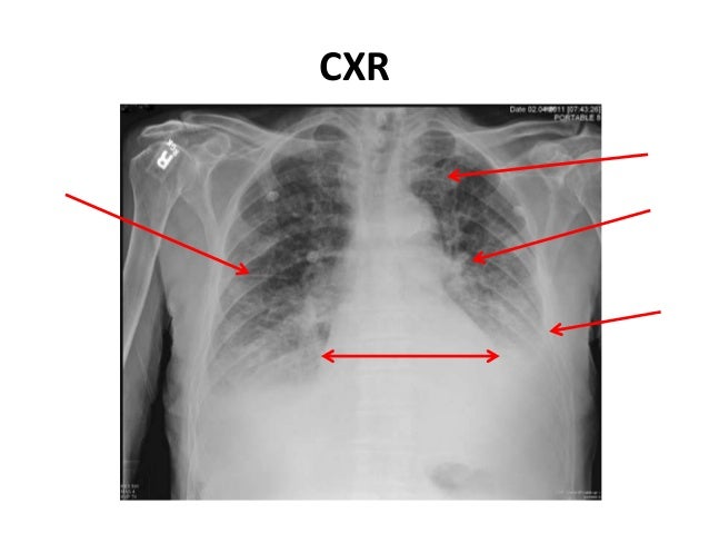 Acute pulmonary edema