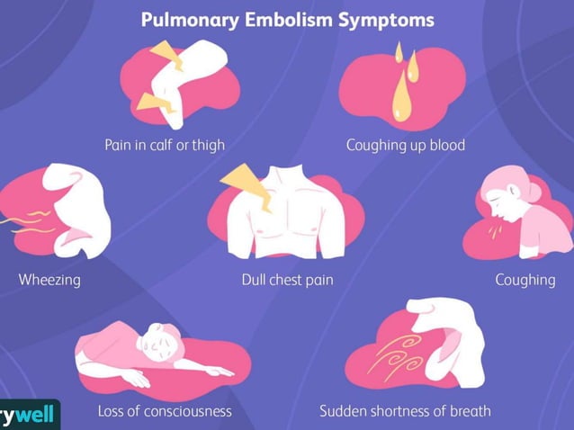 Acute pulmonary embolism and its management. | PPTX