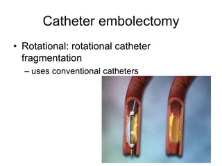 Acute pulmonary embolism case based | PPT