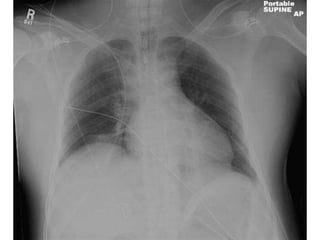 Acute pulmonary embolism case based | PPT