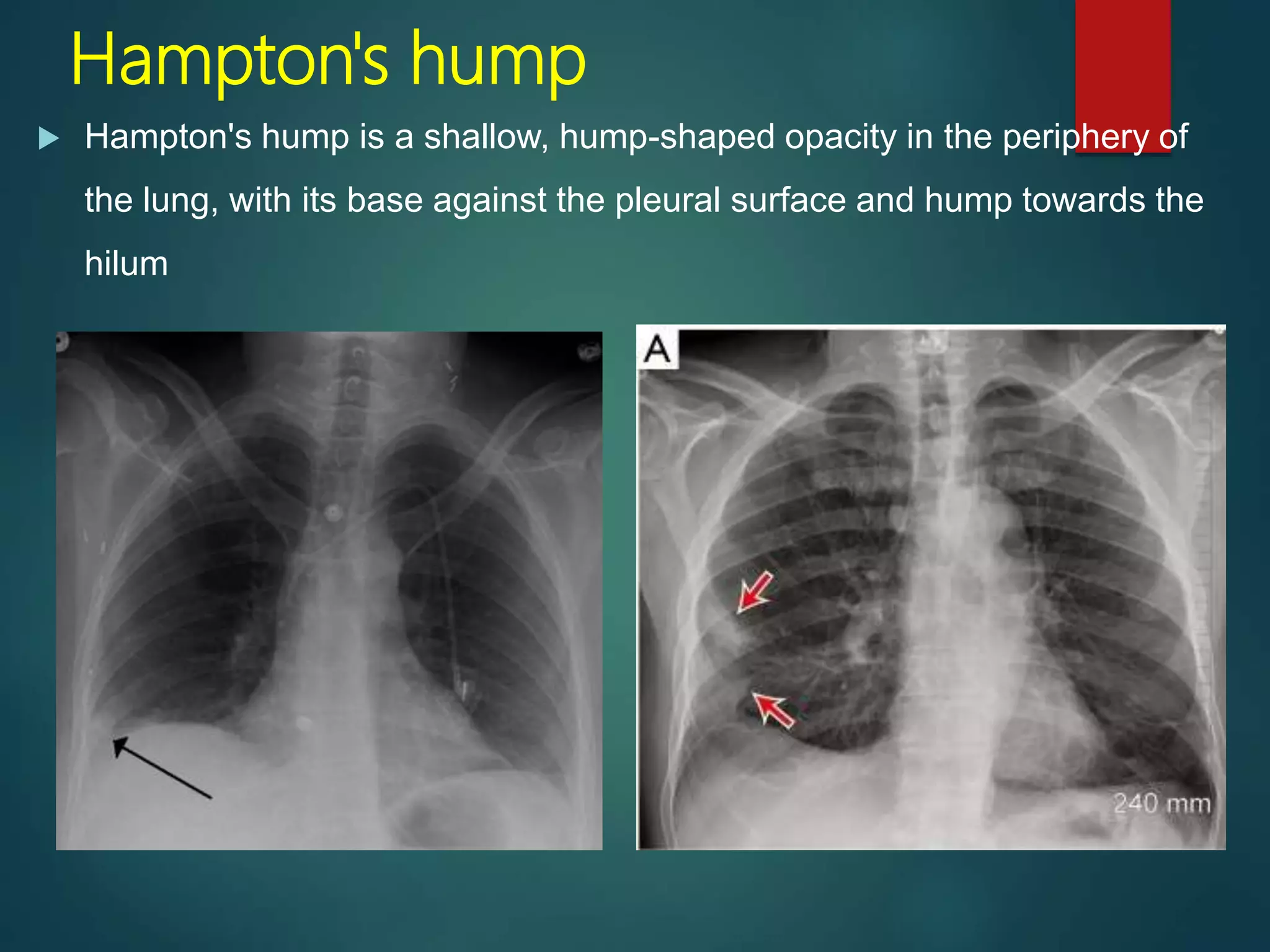 Acute Pulmonary Embolism: Introduction, Clinical presentation ...