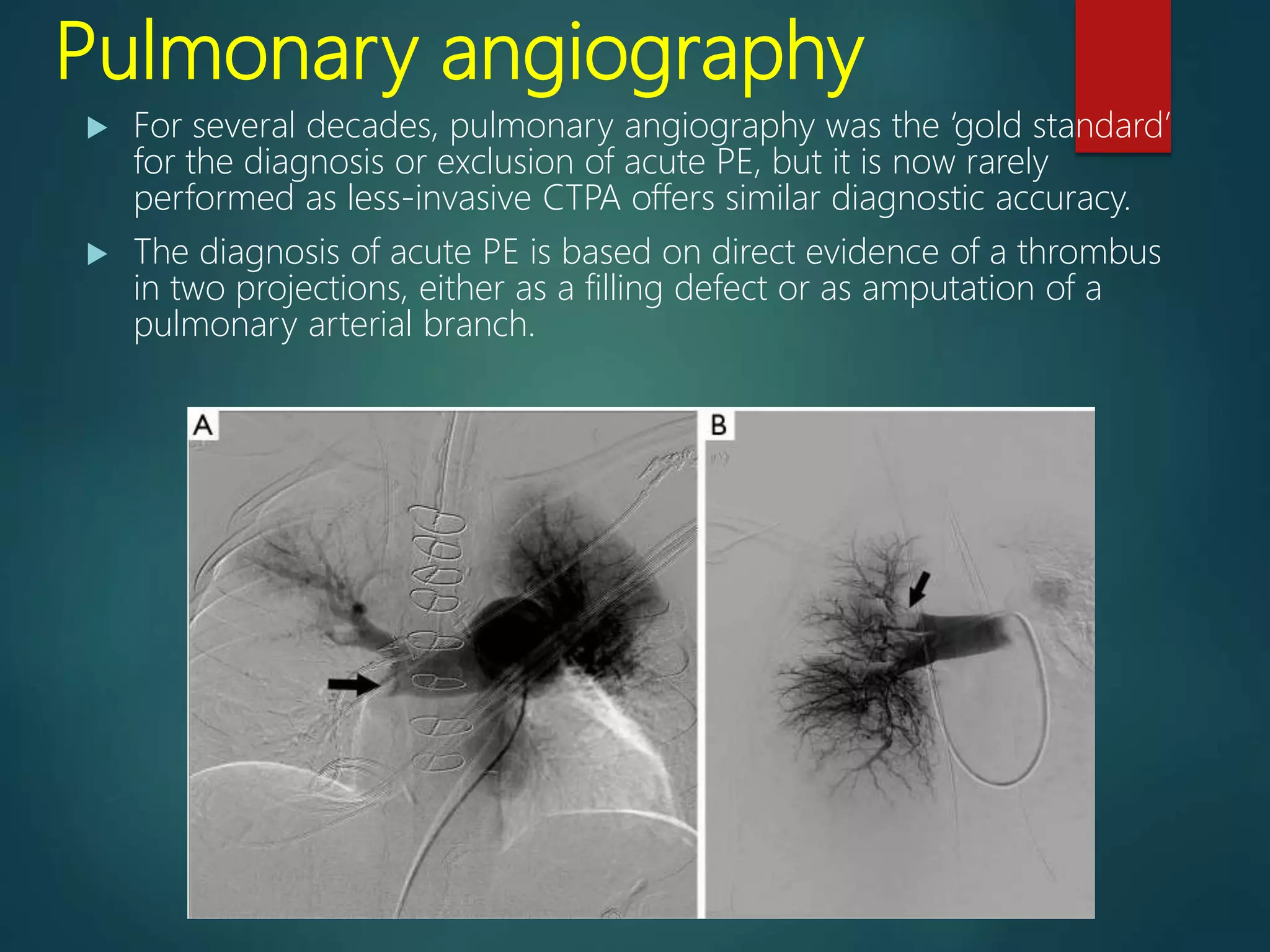 Acute Pulmonary Embolism: Introduction, Clinical presentation ...