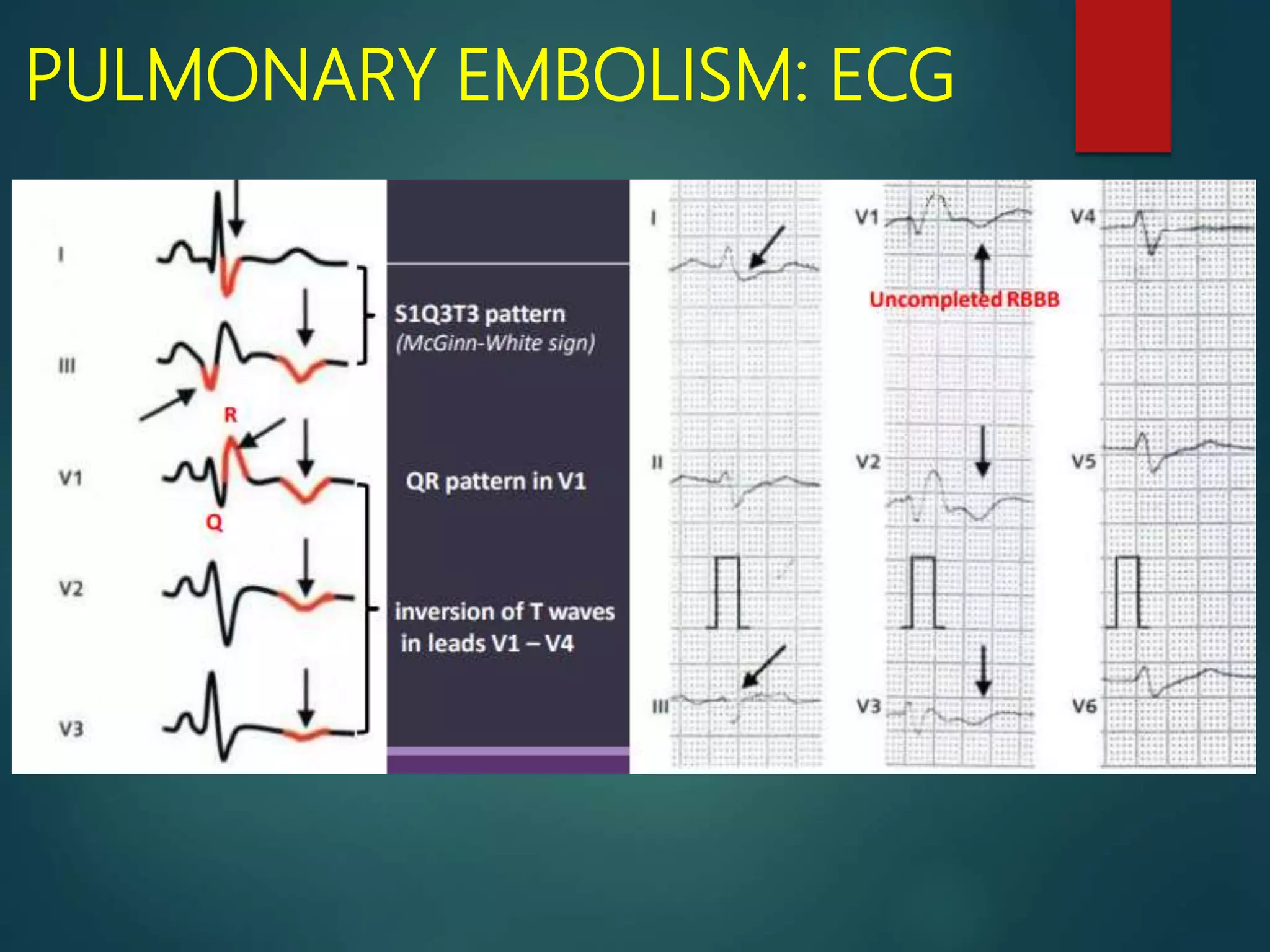 Acute Pulmonary Embolism: Introduction, Clinical presentation ...