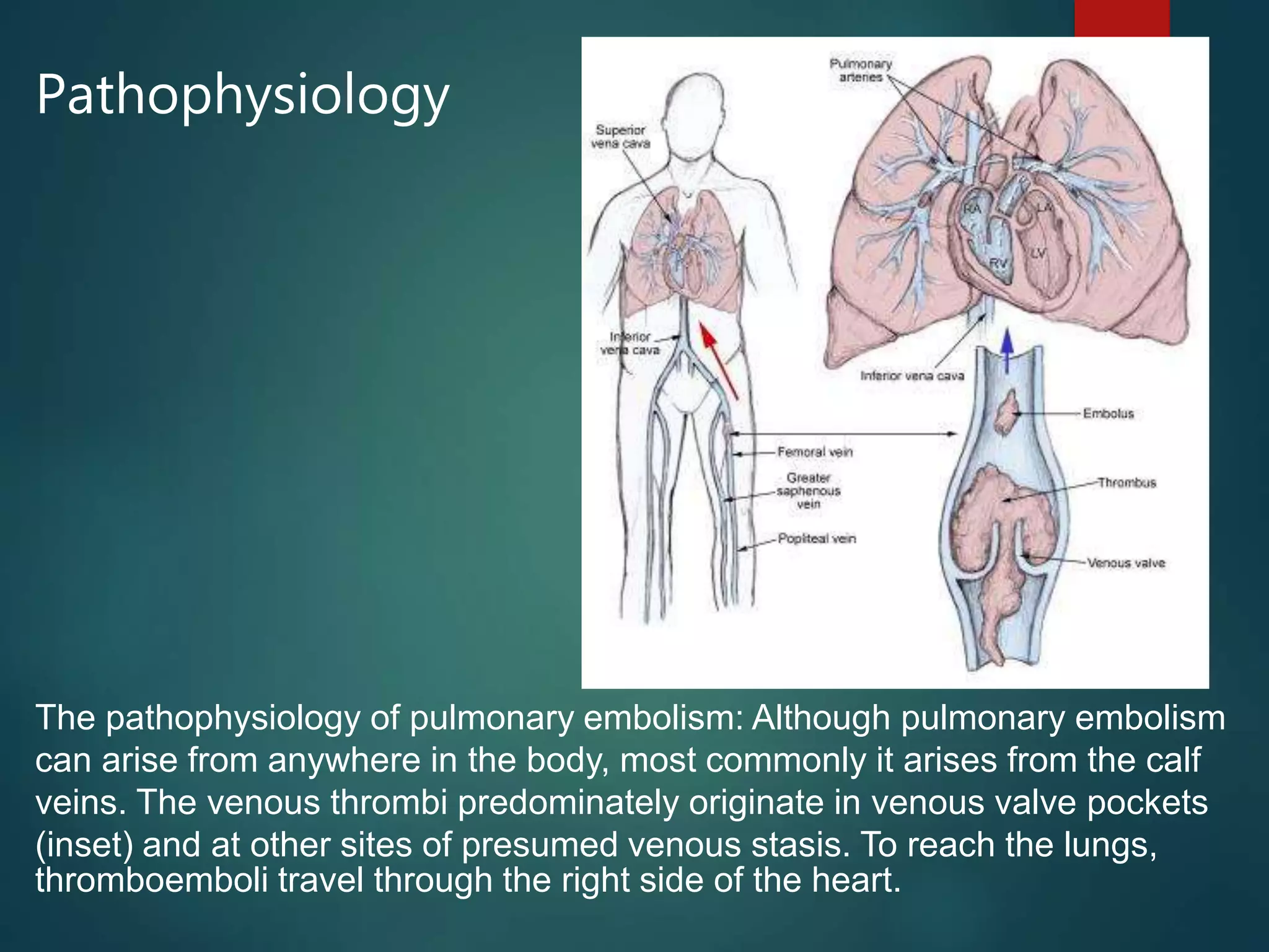 Acute Pulmonary Embolism: Introduction, Clinical presentation ...