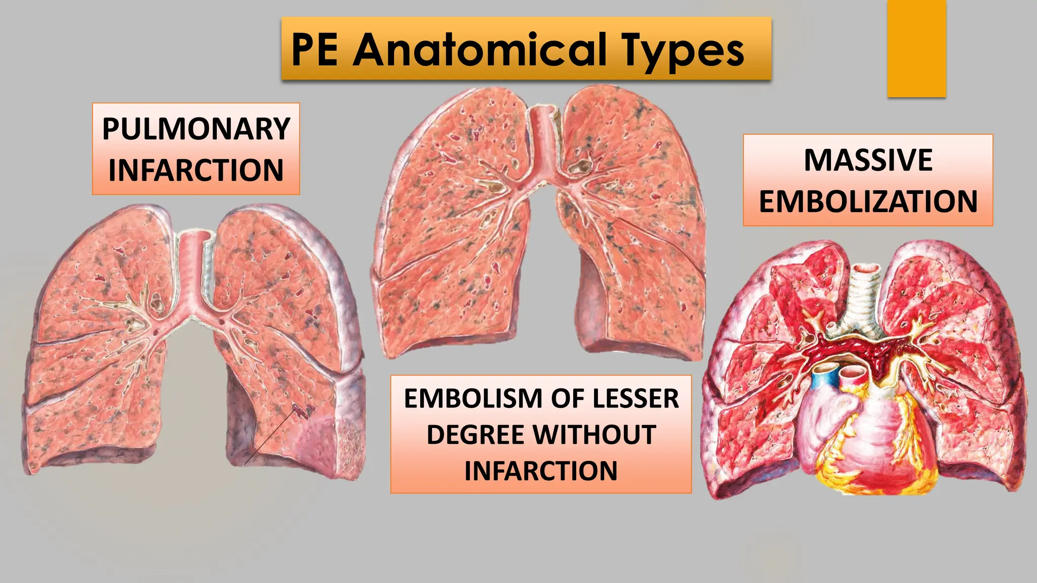 ABDULRAHMAN AL RAFIQ UPDATED MANAGEMENT OF ACUTE PULMONARY EMBOLISM .pdf