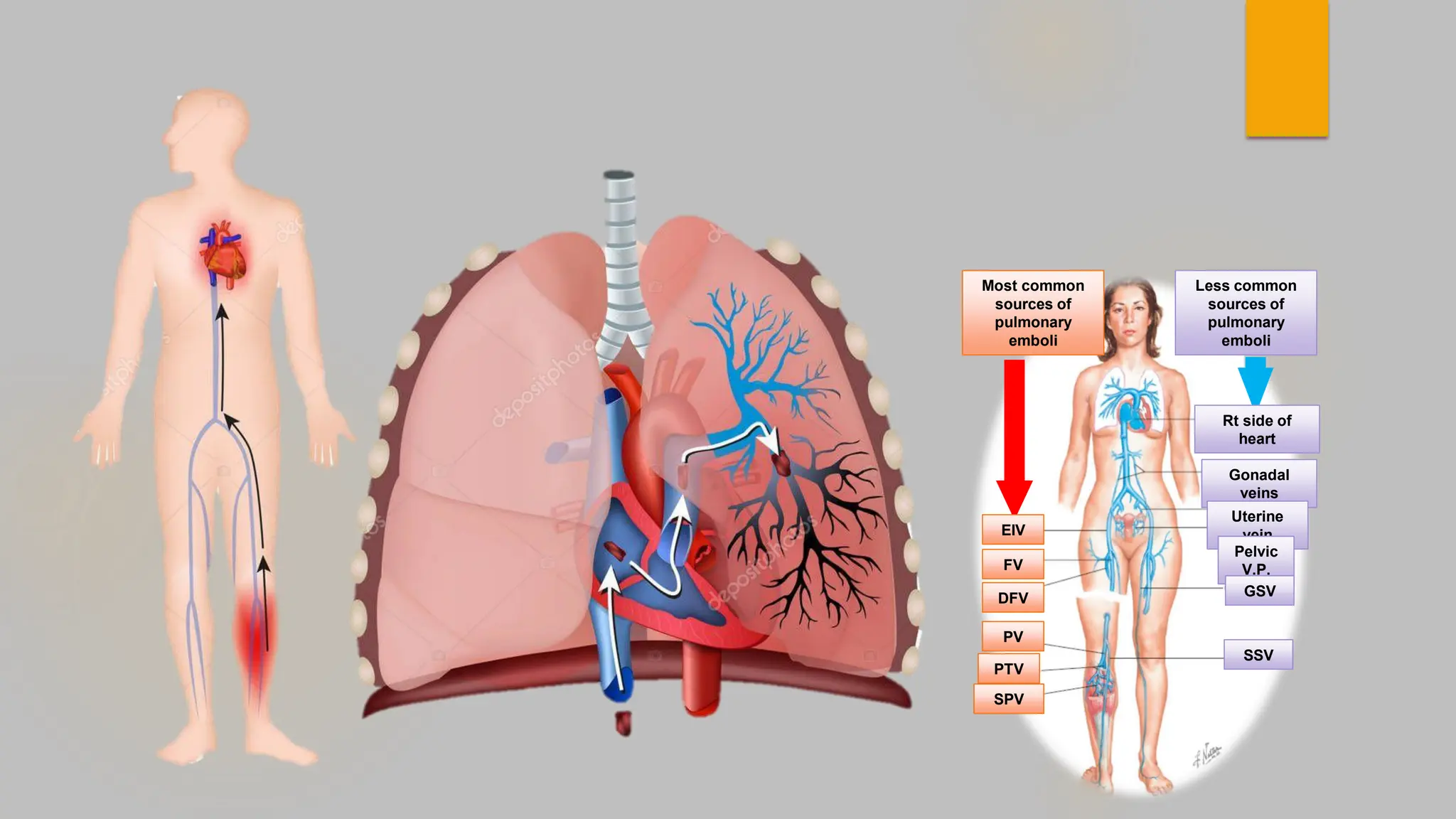 ABDULRAHMAN AL RAFIQ UPDATED MANAGEMENT OF ACUTE PULMONARY EMBOLISM .pdf