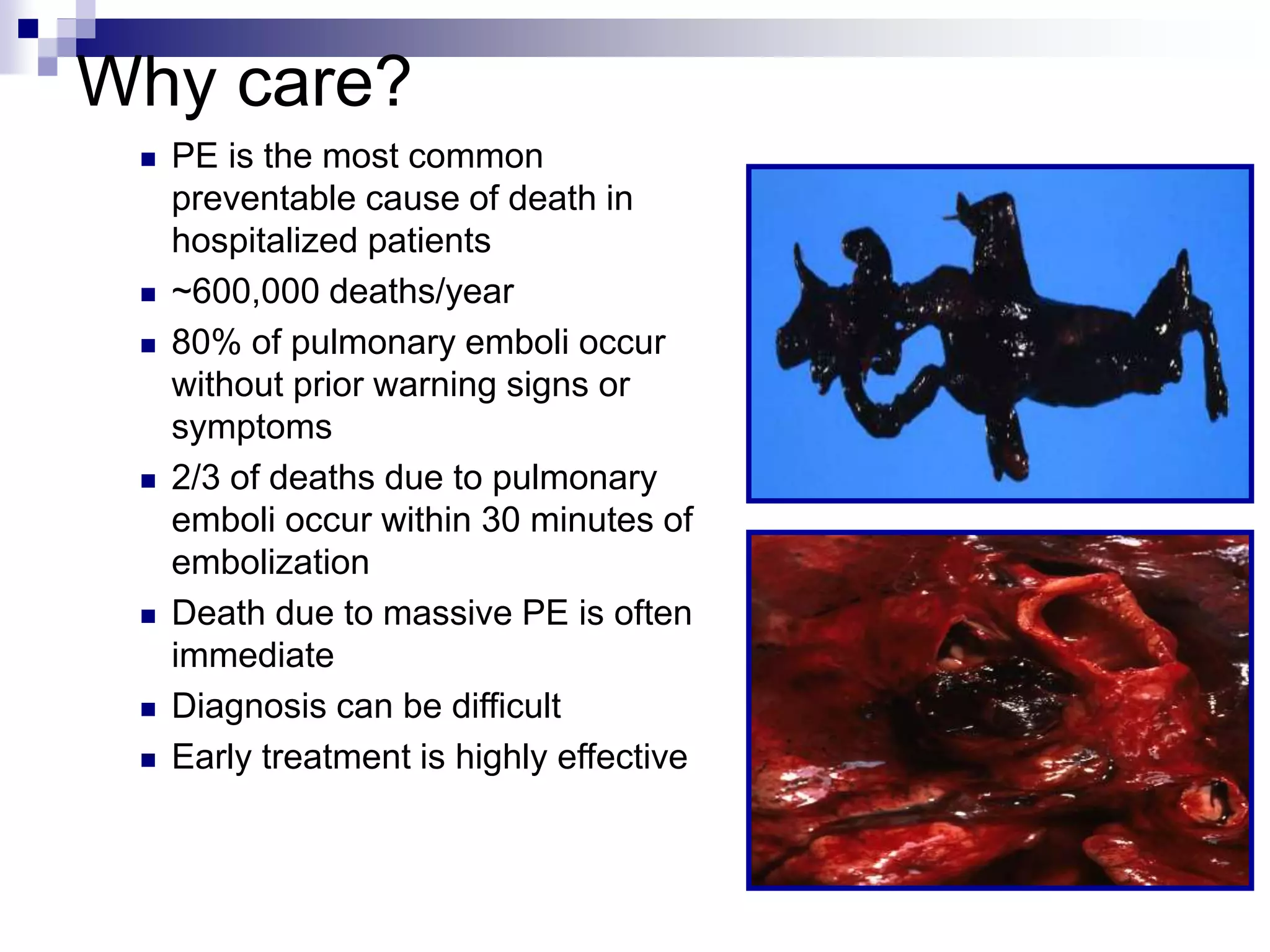 Acute Pulmonary Embolism Overview lecture.ppt