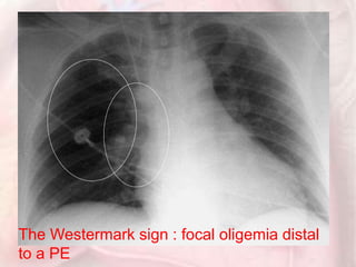 Acute Pulmonary Embolism | PPT