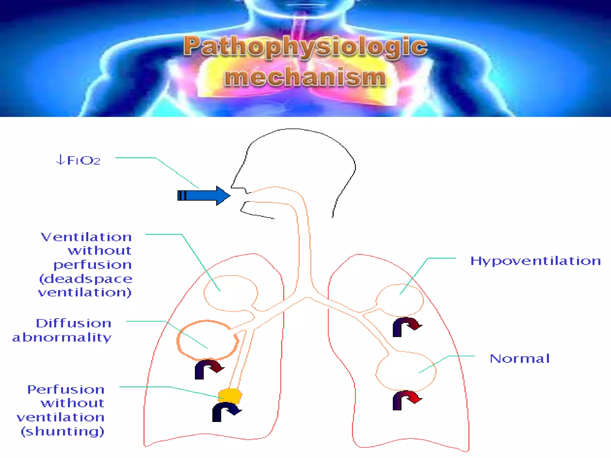 Acute pulmonary failure. | PPT
