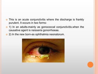 Acute purulent conjunctivitis | PPTX