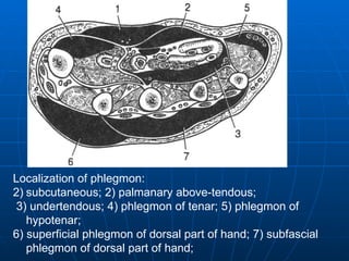 Acute purulent diseases of fingers and hand | PPT