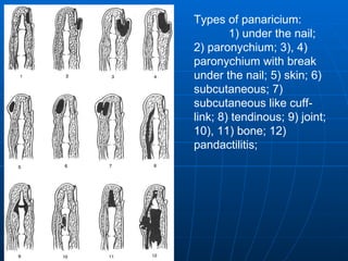 Acute purulent diseases of fingers and hand | PPT